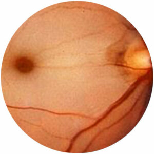 Ophthalmology Services at Connecticut Retina Consultants