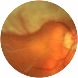 Retina Specialist Near Me in Connecticut | Convenient Locations